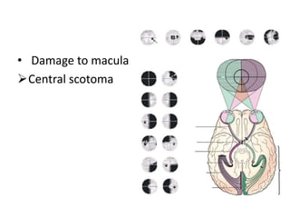 Visual field defects | PPTX