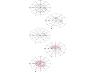 Visual field defects | PPTX