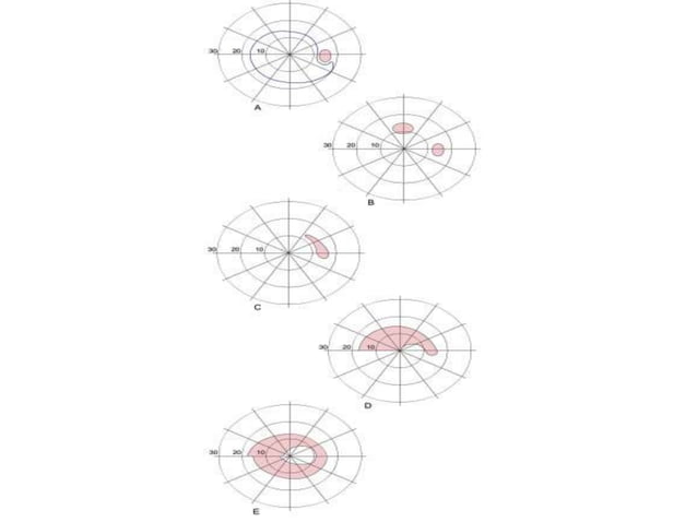 Visual Field Defects Pptx