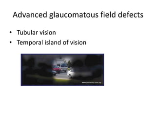 Visual field defects | PPTX