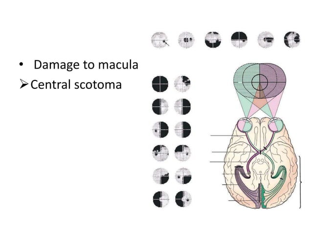 Visual field defects
