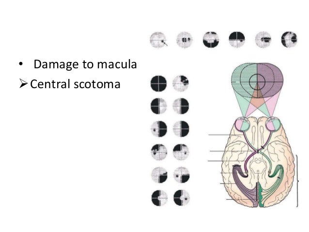 Visual field defects