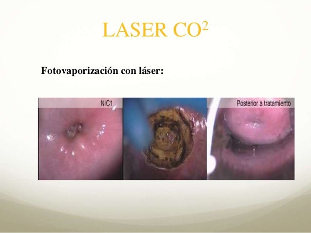 Neoplasia Intraepitelial Cervical