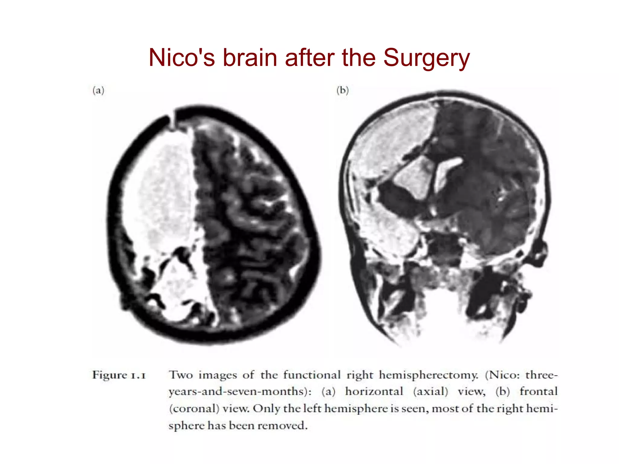 Re-thinking about the brain [based on the case of Nico-with half a brain] | PPT