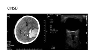 Non-Invasive ICP Monitoring for Neurosurgeons | PPT