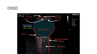 Non-Invasive ICP Monitoring for Neurosurgeons | PPTX