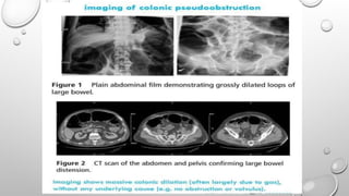 motility disorders in pediatrics advances | PPTX