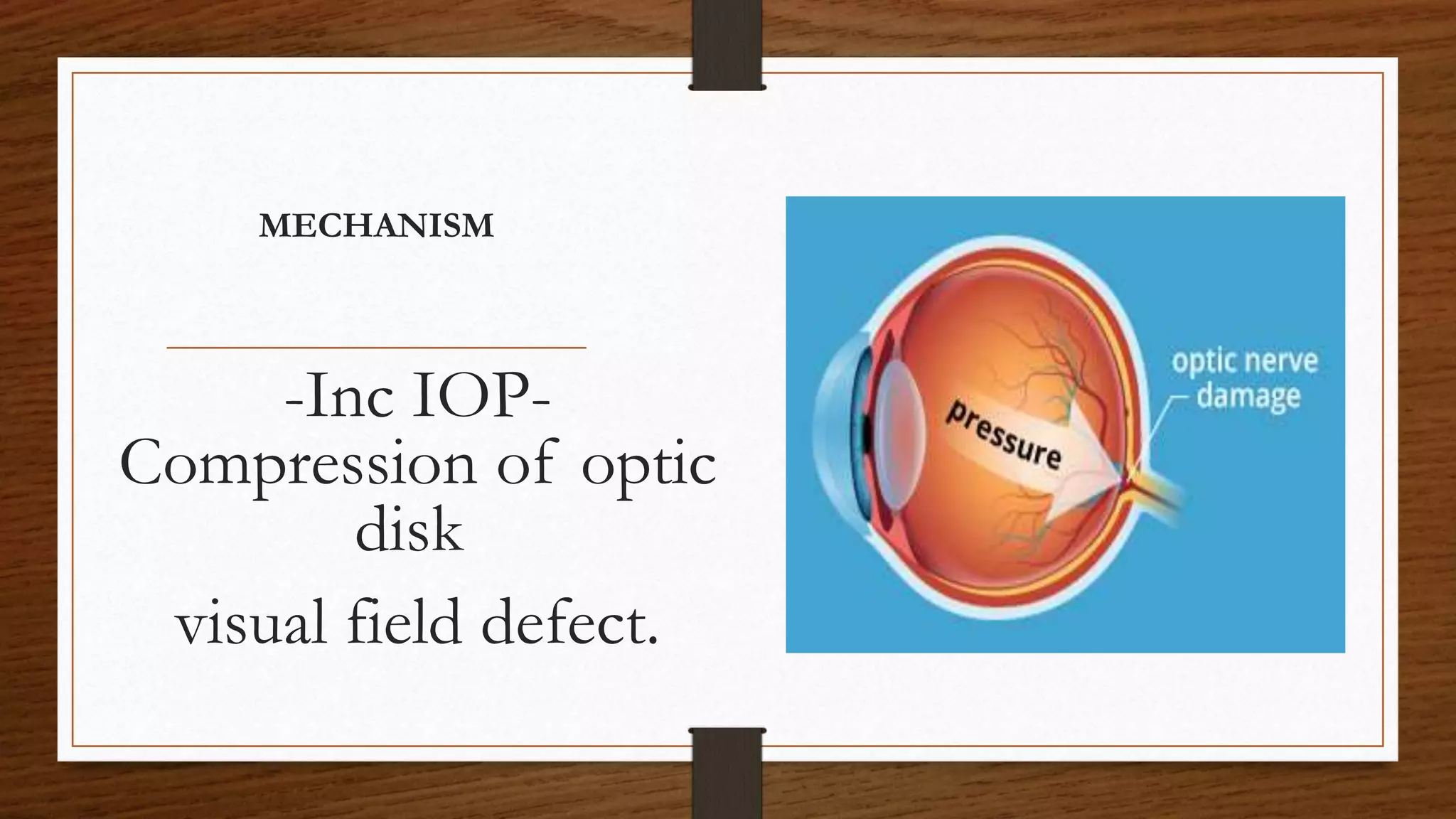 GLAUCOMA | PPTX