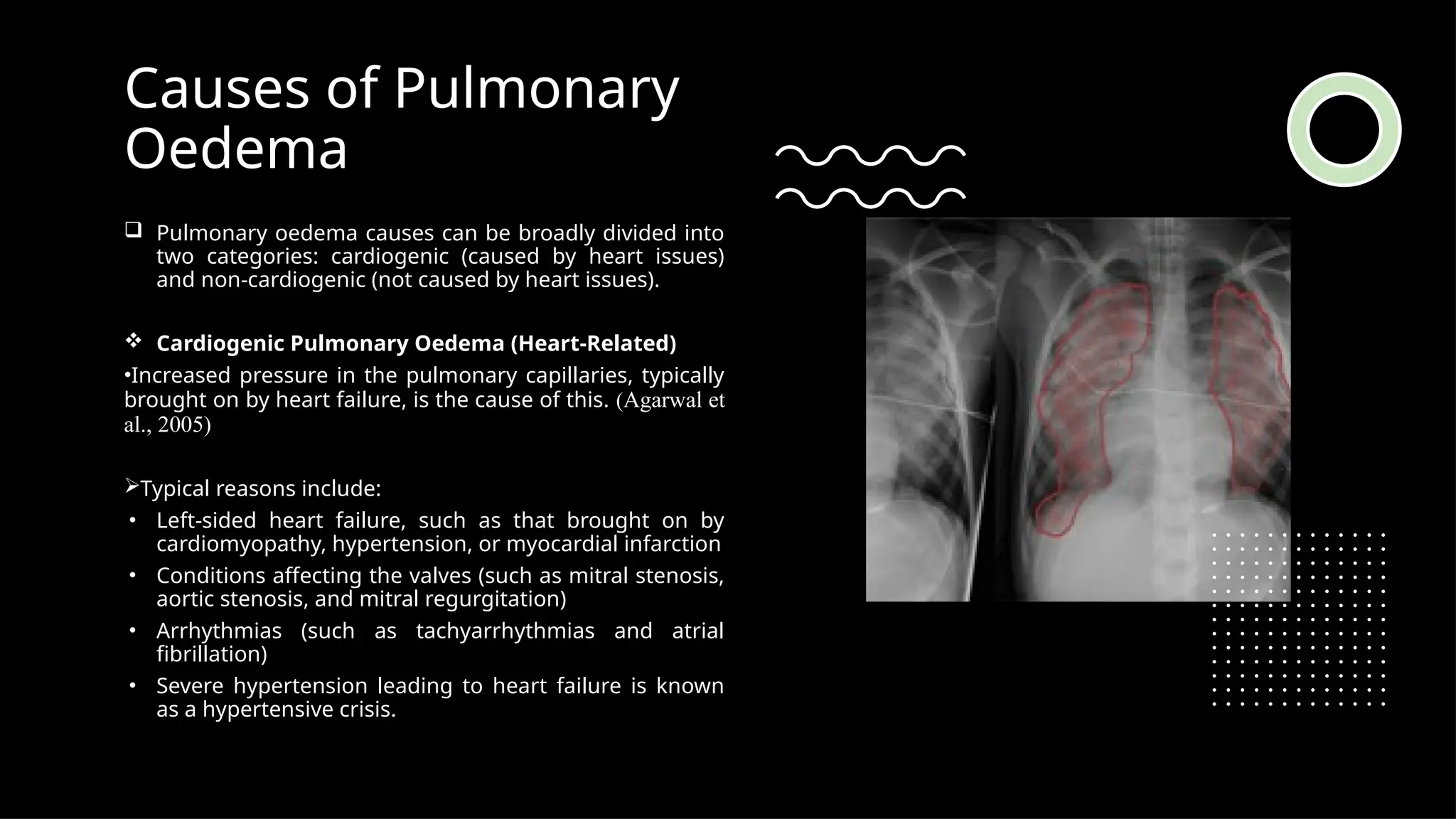 Participation of a physiotherapist in a patient with pulmonary oedema Nigel Chirwa Presentation.pptx