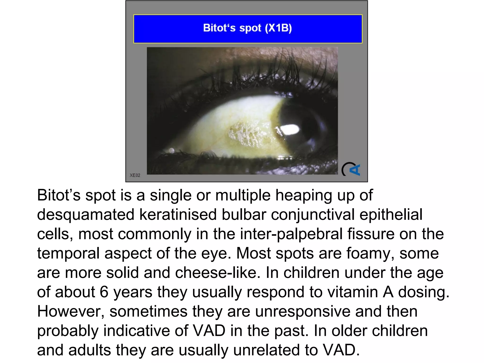 Nightblindness and xerophthalmia | PPT