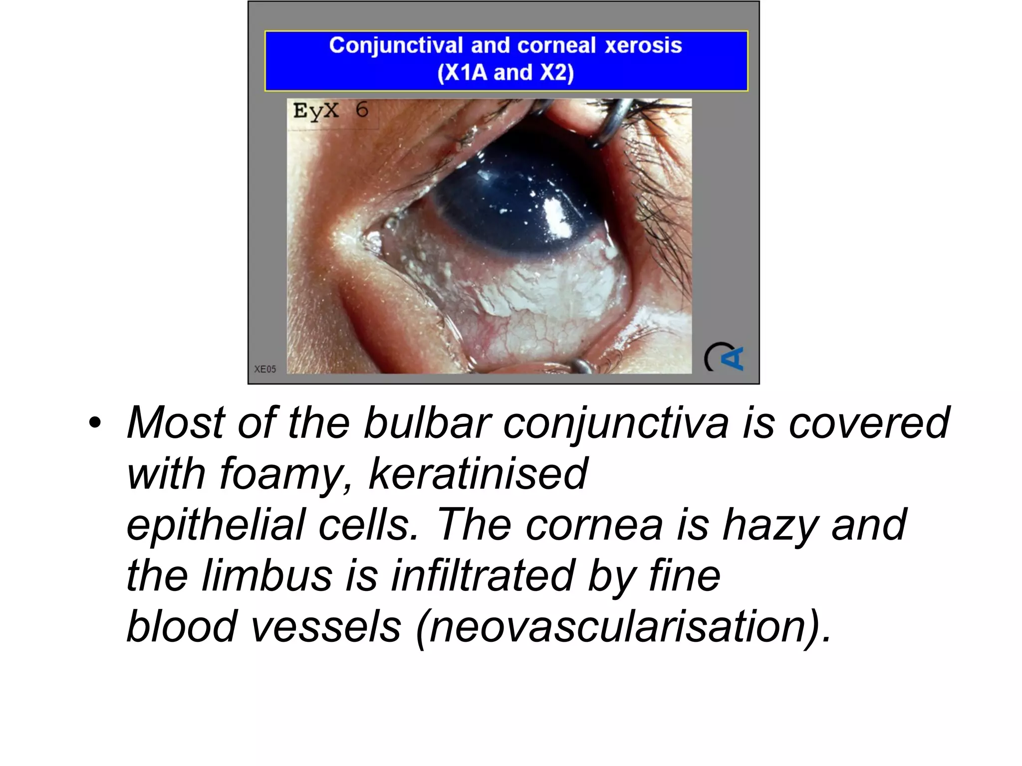 Nightblindness and xerophthalmia | PPT