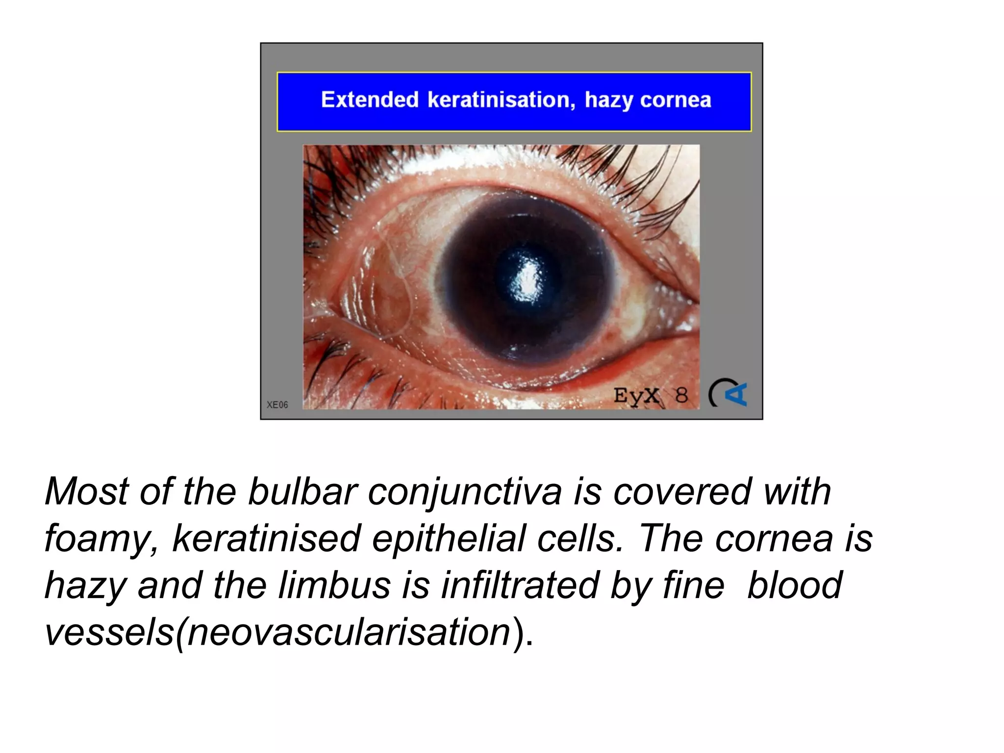 Nightblindness and xerophthalmia | PPT