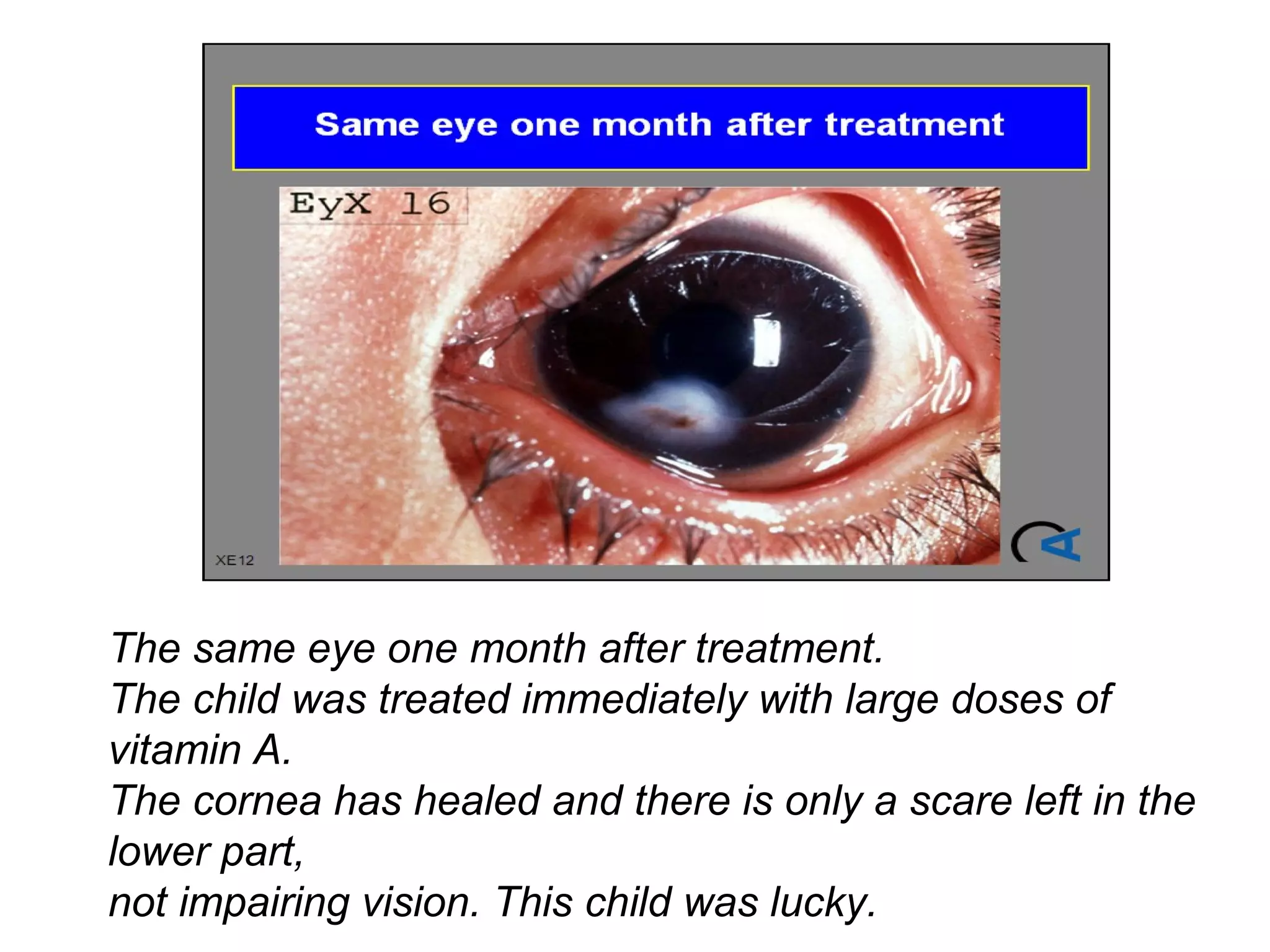 Nightblindness and xerophthalmia | PPT