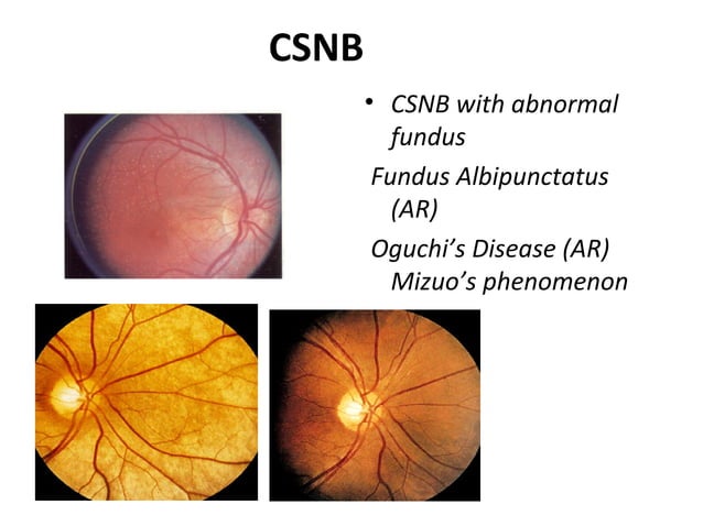 Nightblindness and xerophthalmia | PPT