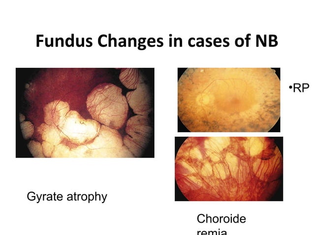 Nightblindness and xerophthalmia | PPT