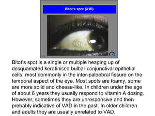 Nightblindness and xerophthalmia | PPT