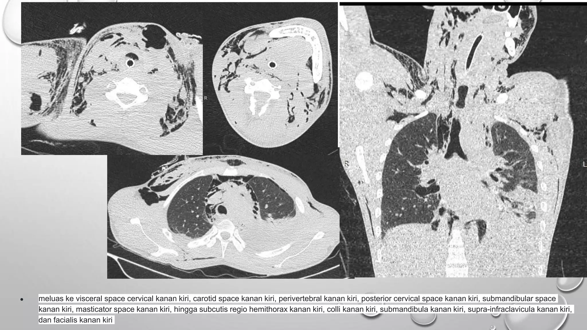 Tracheobronchial Injury | PPTX
