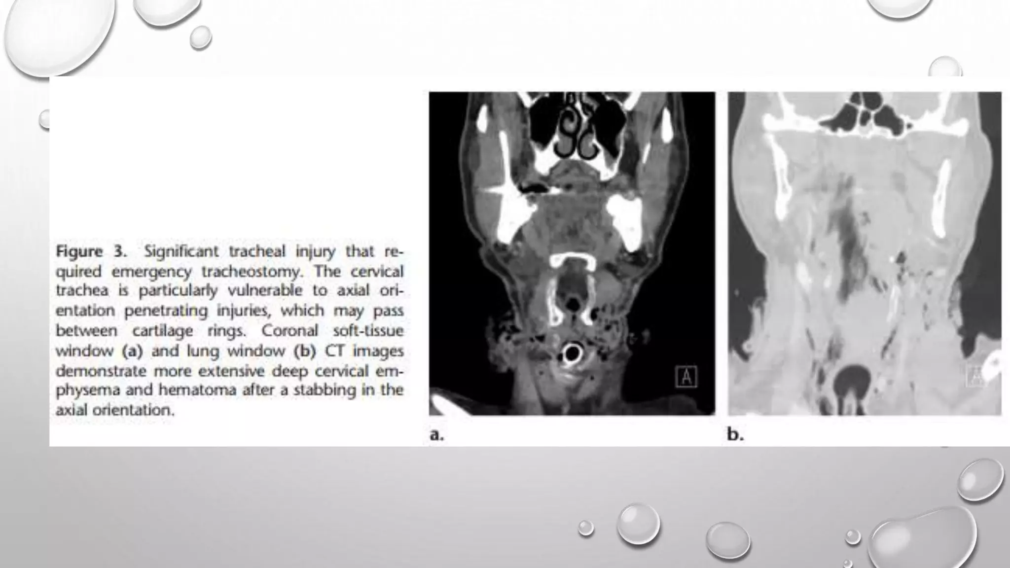 Tracheobronchial Injury | PPTX