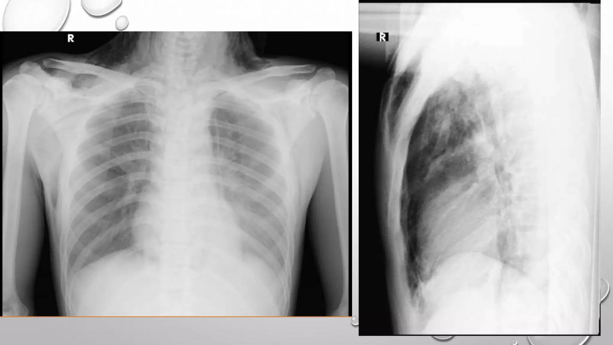 Tracheobronchial Injury | PPTX