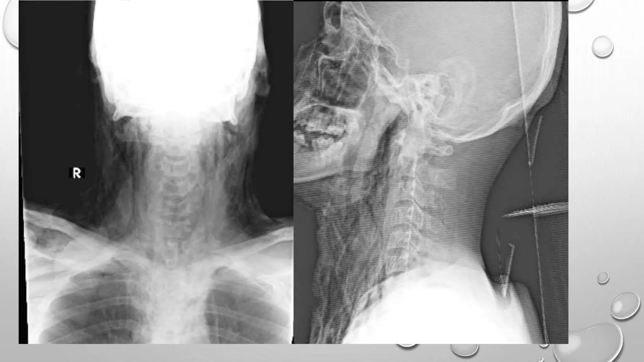 Tracheobronchial Injury | PPTX