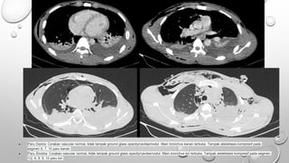 Tracheobronchial Injury | PPTX