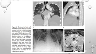 Tracheobronchial Injury | PPTX