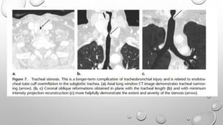 Tracheobronchial Injury | PPTX