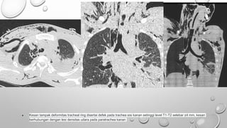 Tracheobronchial Injury | PPTX