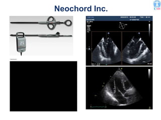 new technologies for Mitral regurgitation | PPTX