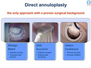 new technologies for Mitral regurgitation | PPTX