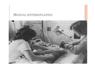 Use of Manual Hyperinflation in ICU | PPTX