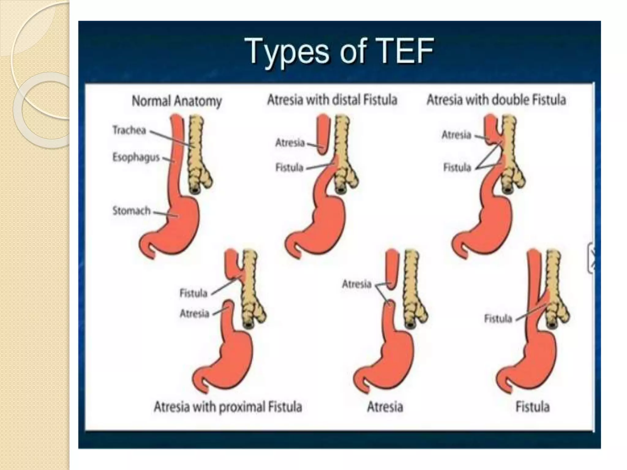 TRACHEOESOPHAGEAL FISTULA | PPTX
