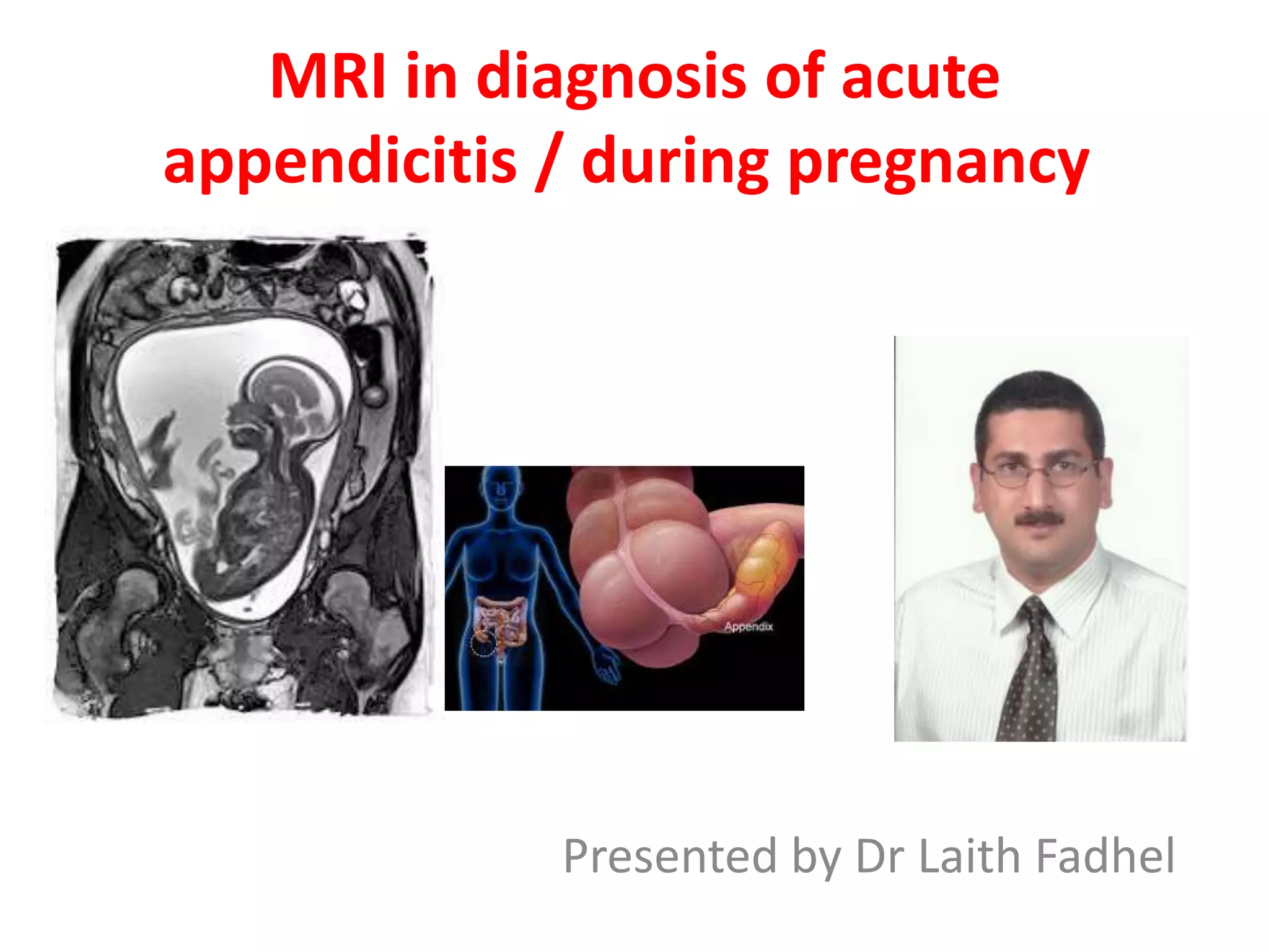 Mri in diagnosis of acute appendicitis during pregnancy | PPT