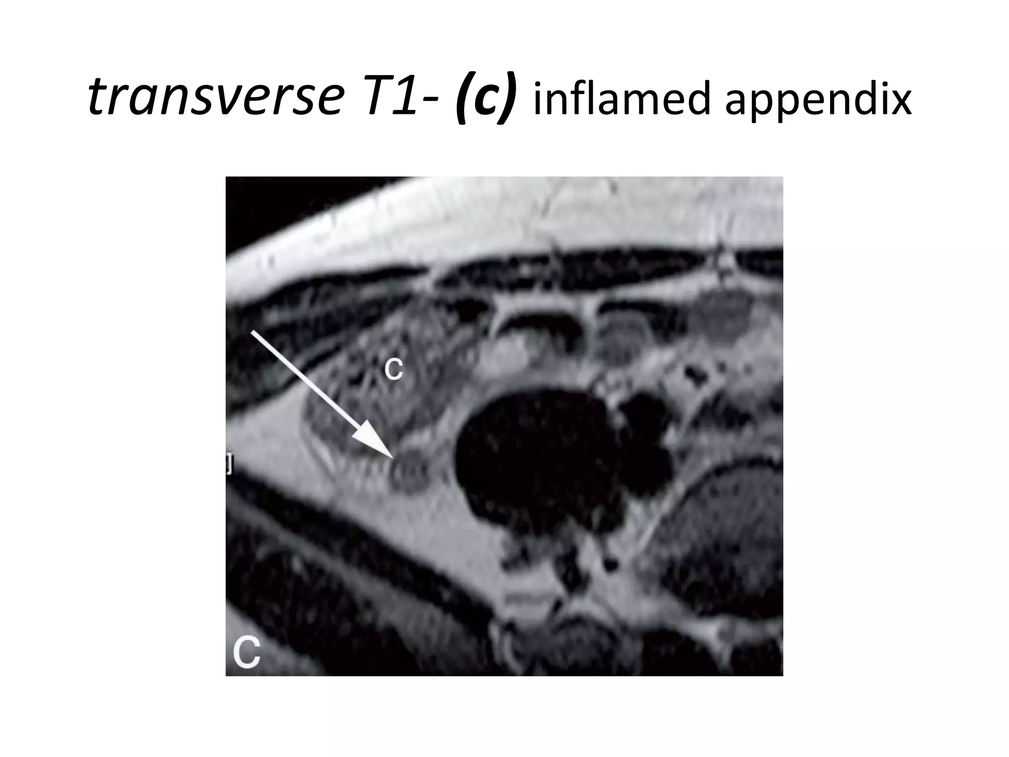Mri in diagnosis of acute appendicitis during pregnancy | PPTX