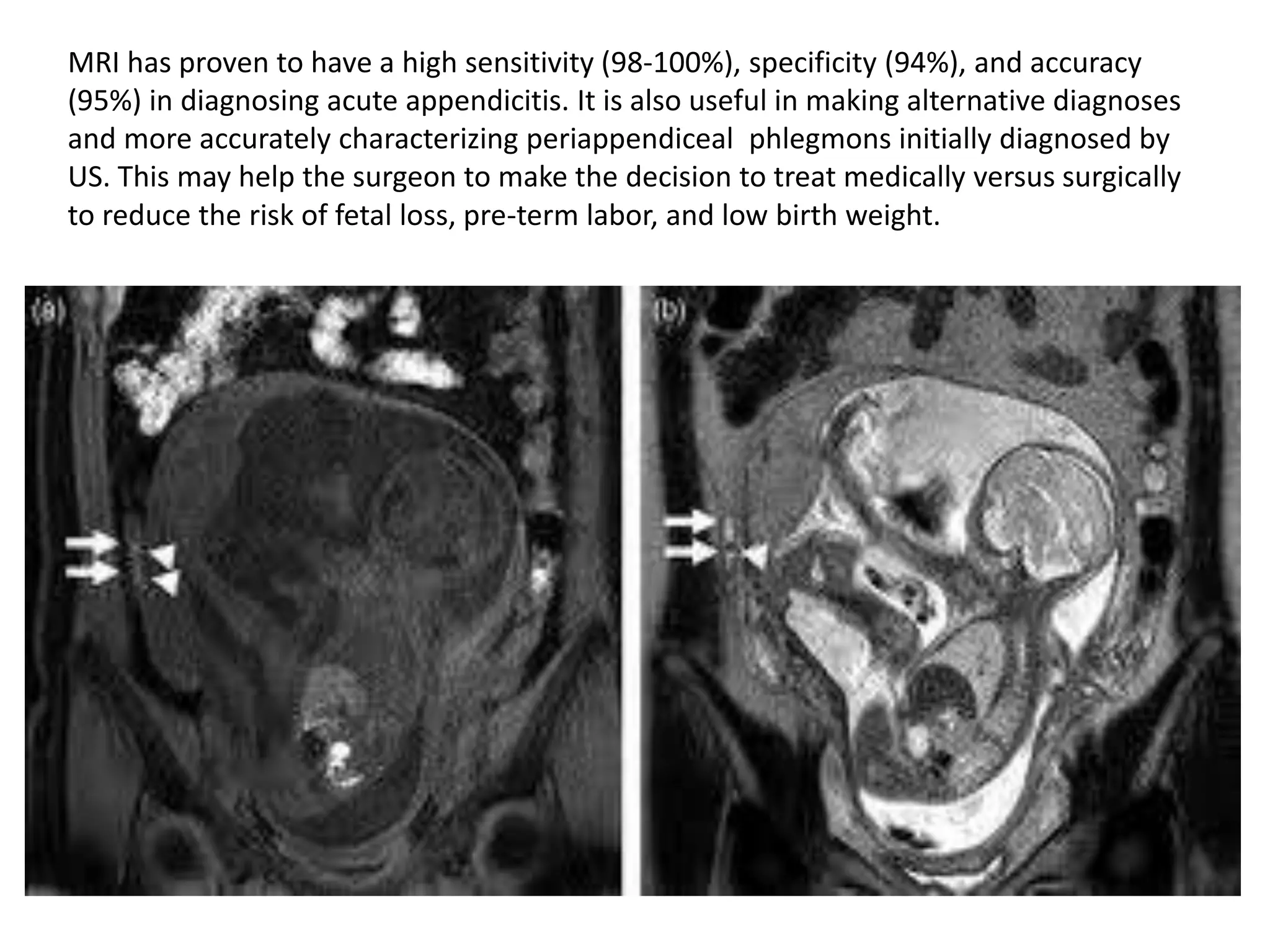 Mri in diagnosis of acute appendicitis during pregnancy | PPT