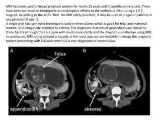Mri in diagnosis of acute appendicitis during pregnancy | PPTX