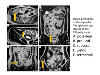 Mri in diagnosis of acute appendicitis during pregnancy | PPT
