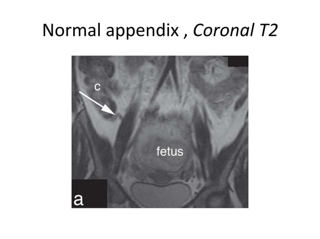 Mri in diagnosis of acute appendicitis during pregnancy | PPT