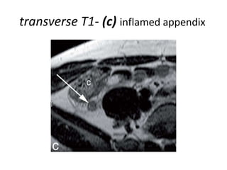 Mri in diagnosis of acute appendicitis during pregnancy | PPT
