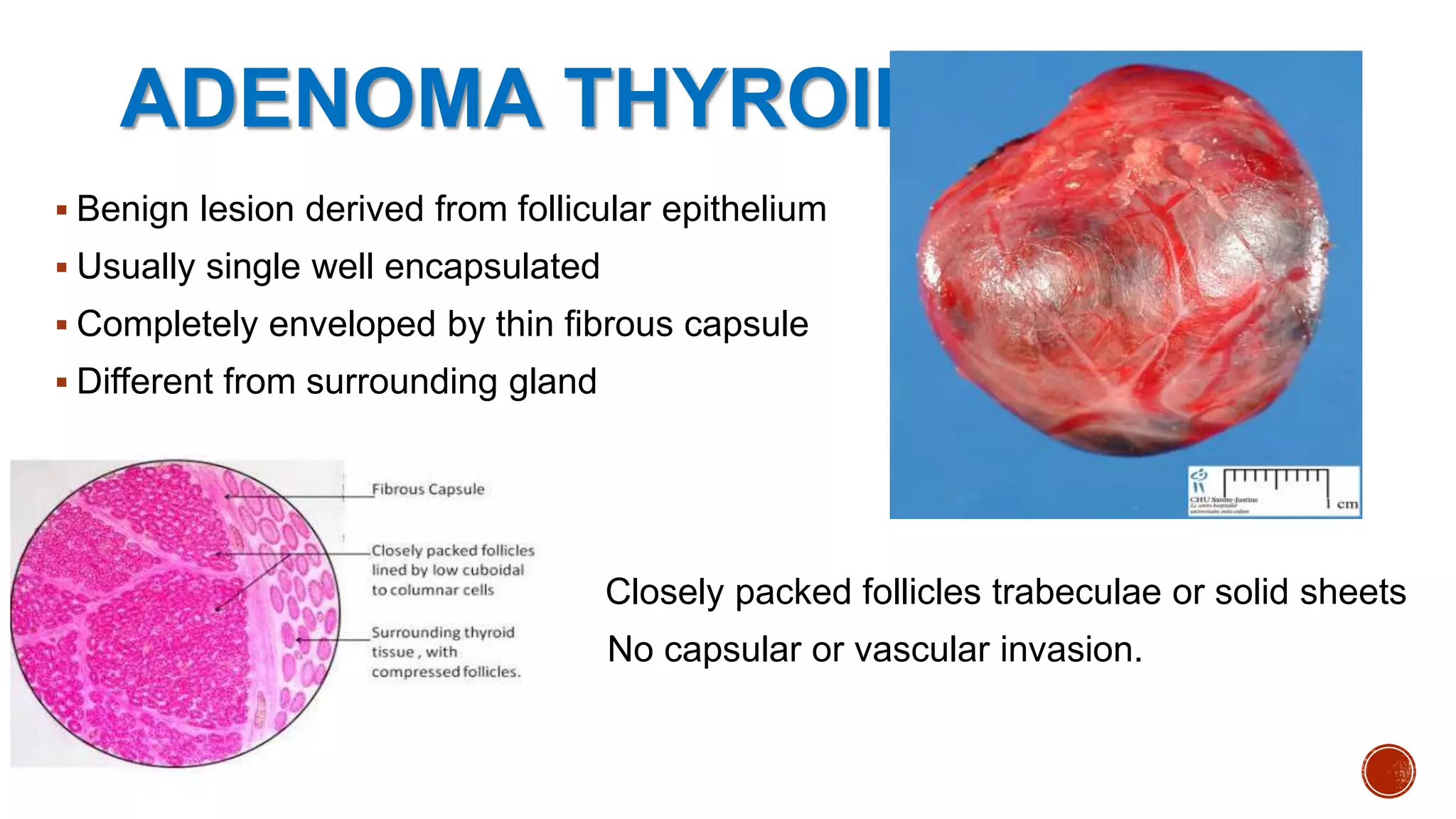 pathogenesis of thyroid carcinoma | PPTX