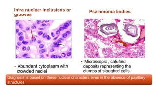 pathogenesis of thyroid carcinoma | PPTX