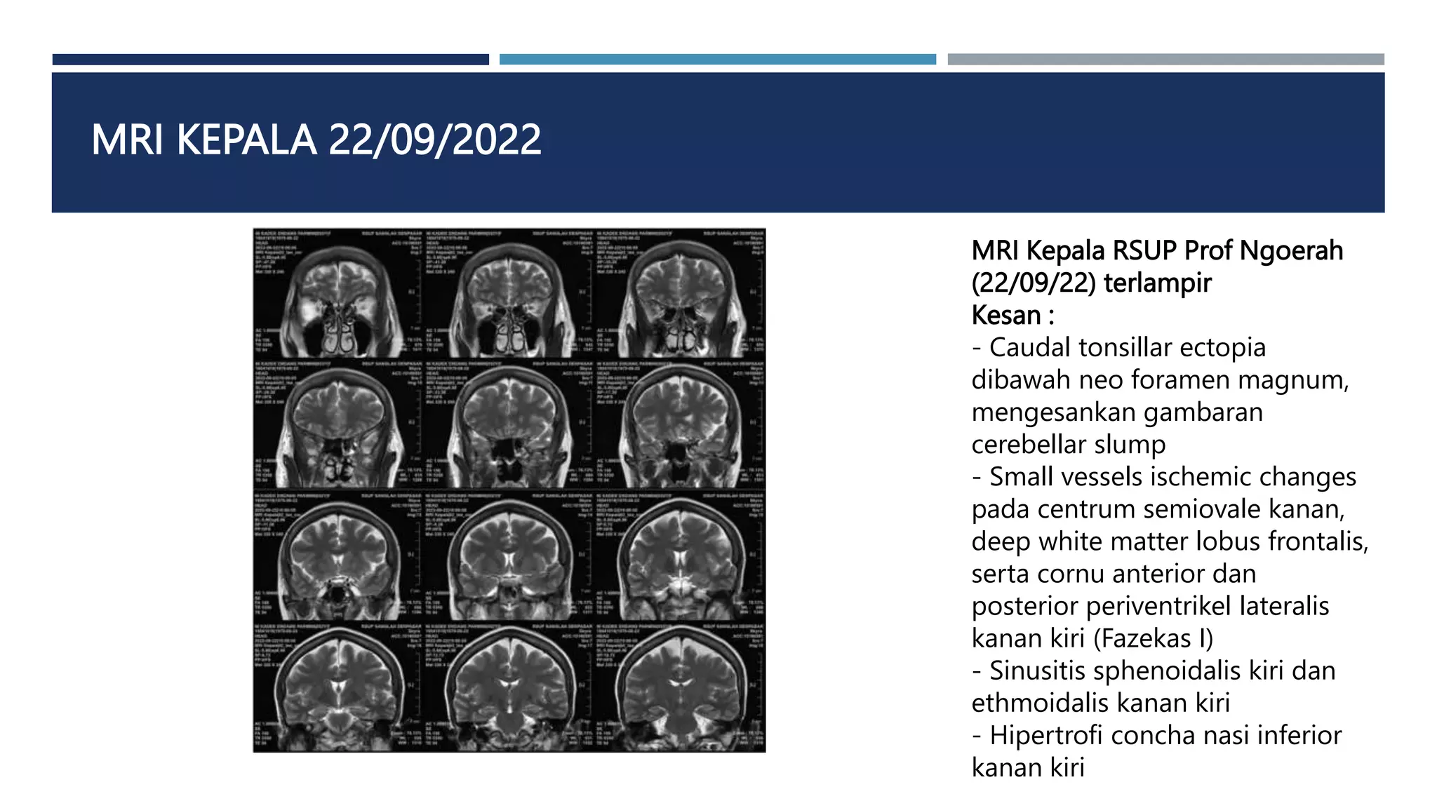Chiari malformation.pptx