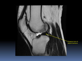 Knee Anatomy Mri