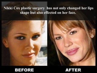 Robin Meade Before And After Plastic Surgery