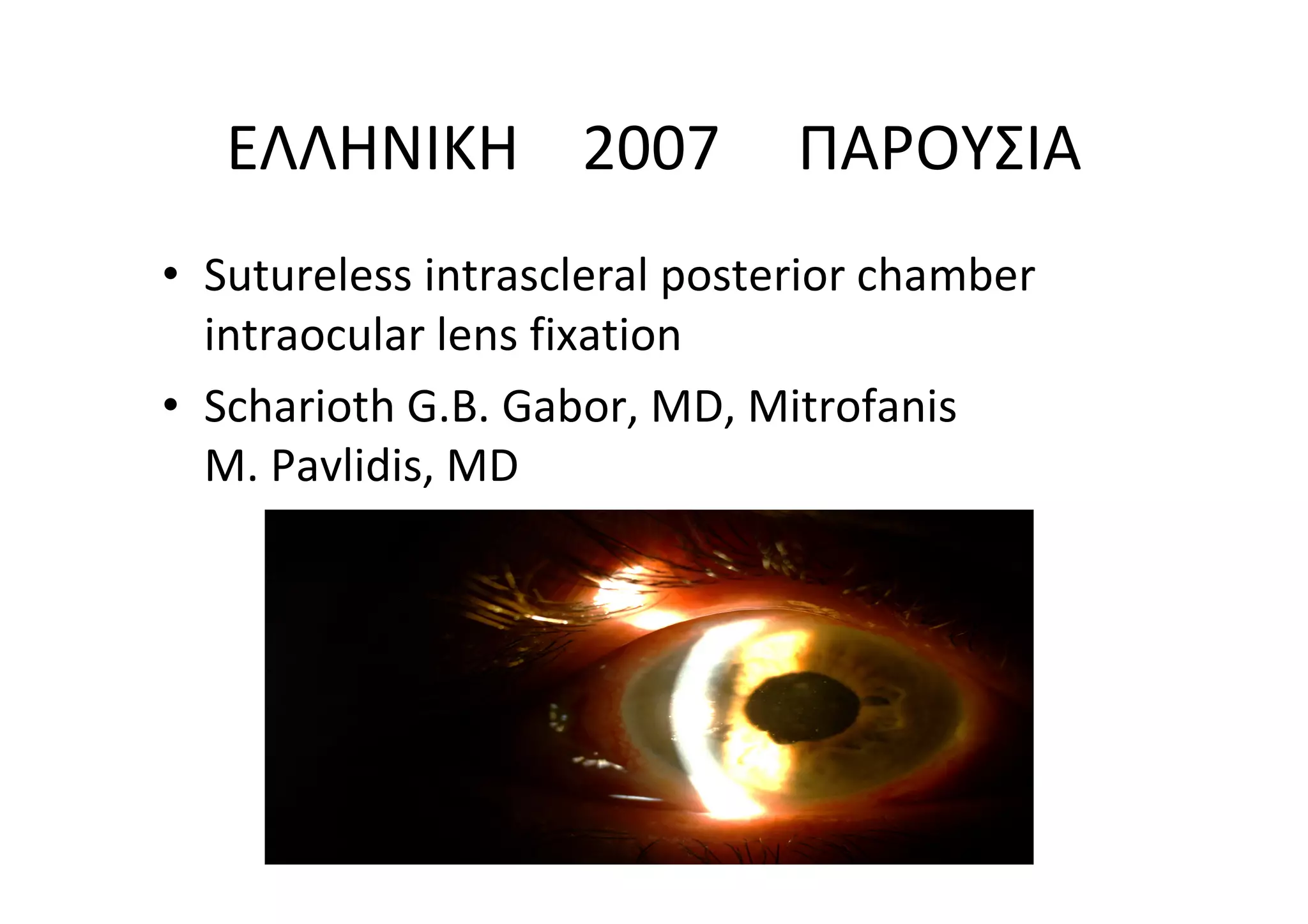 Nikolakopoulos endoscleral iol | PPT