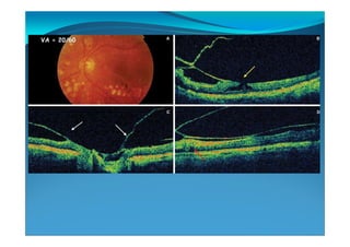 Nikolakopoulos vitrectomy or microplasmin in dme with vitreomacular ...