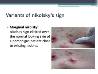 Nikolsky sign
