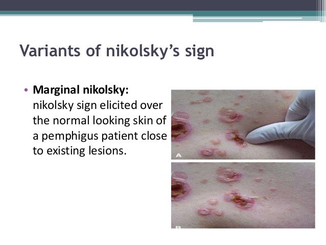 Nikolsky sign