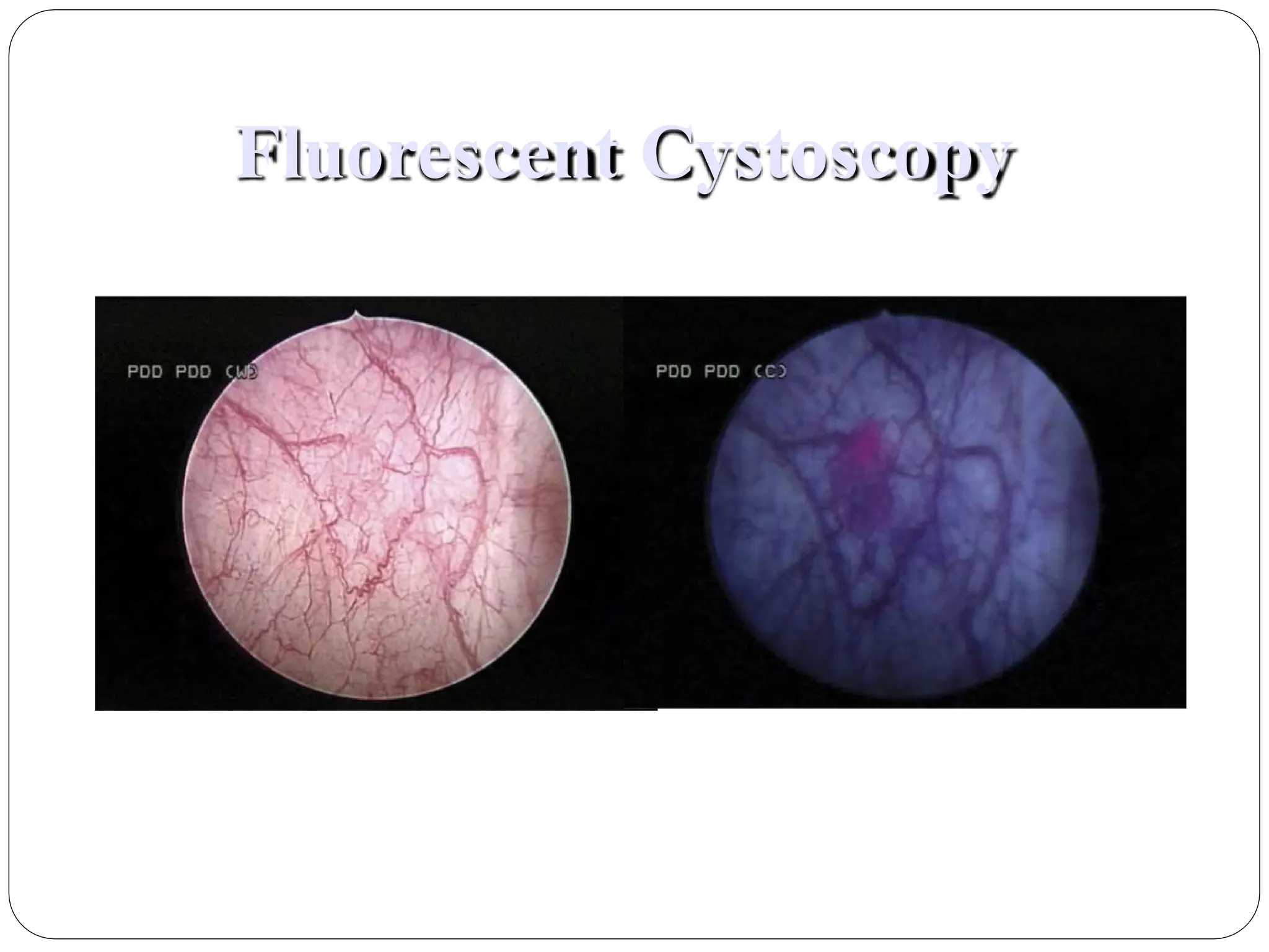 NIMBC ppt final.pptx nonmuscle invasive bladder carcinoma | PPTX