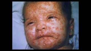 Nina-A presentation about chicken pox and cow pox.pptx